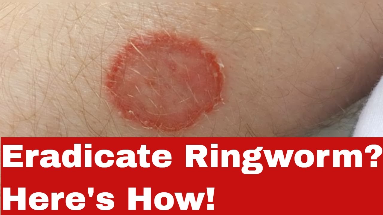 Beat the Itch! How to Get Rid of Ringworm Fast! - YouTube