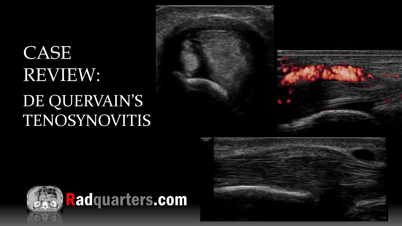 Ultrasound of de Quervain’s Tenosynovitis - YouTube