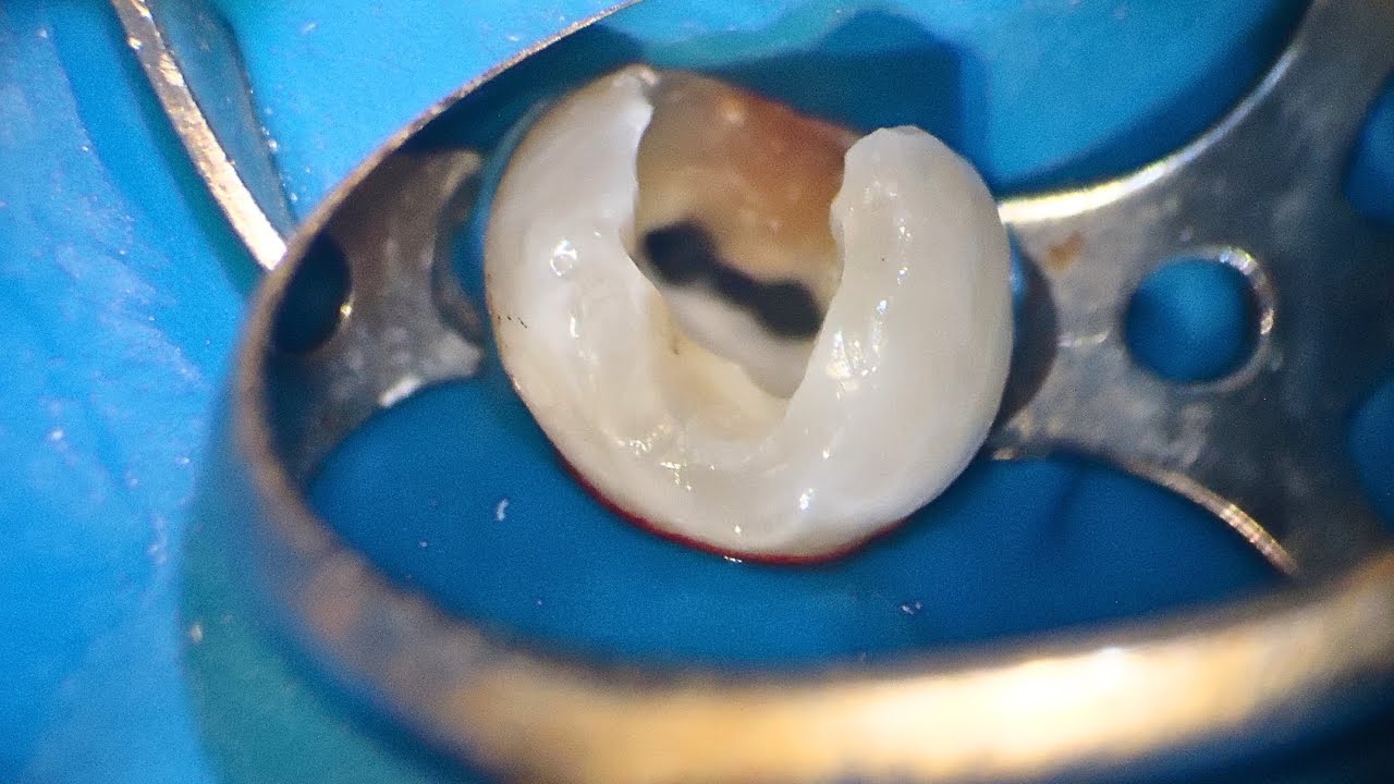 Endodontia Microscópica - dente 45 - YouTube