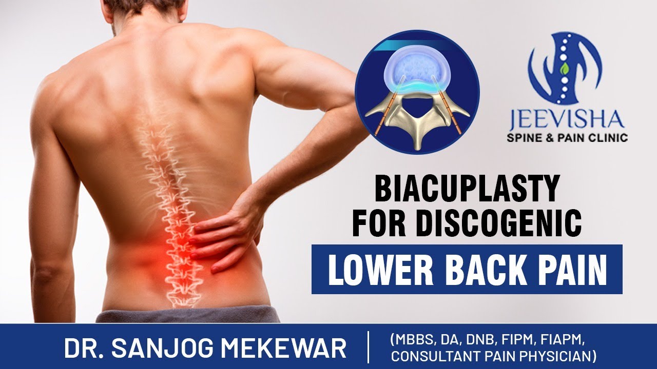 Biacuplasty for Discogenic Lower Back Pain - YouTube
