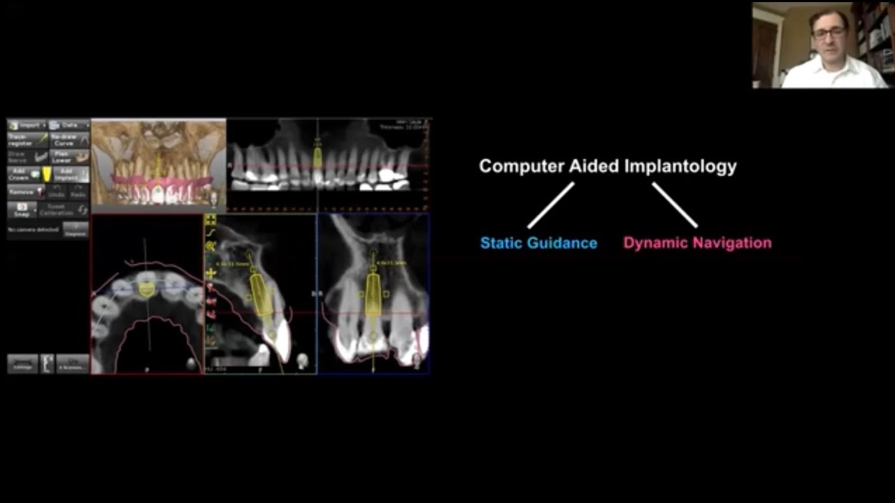 Navident - Dynamic Navigation and All on 4 - YouTube