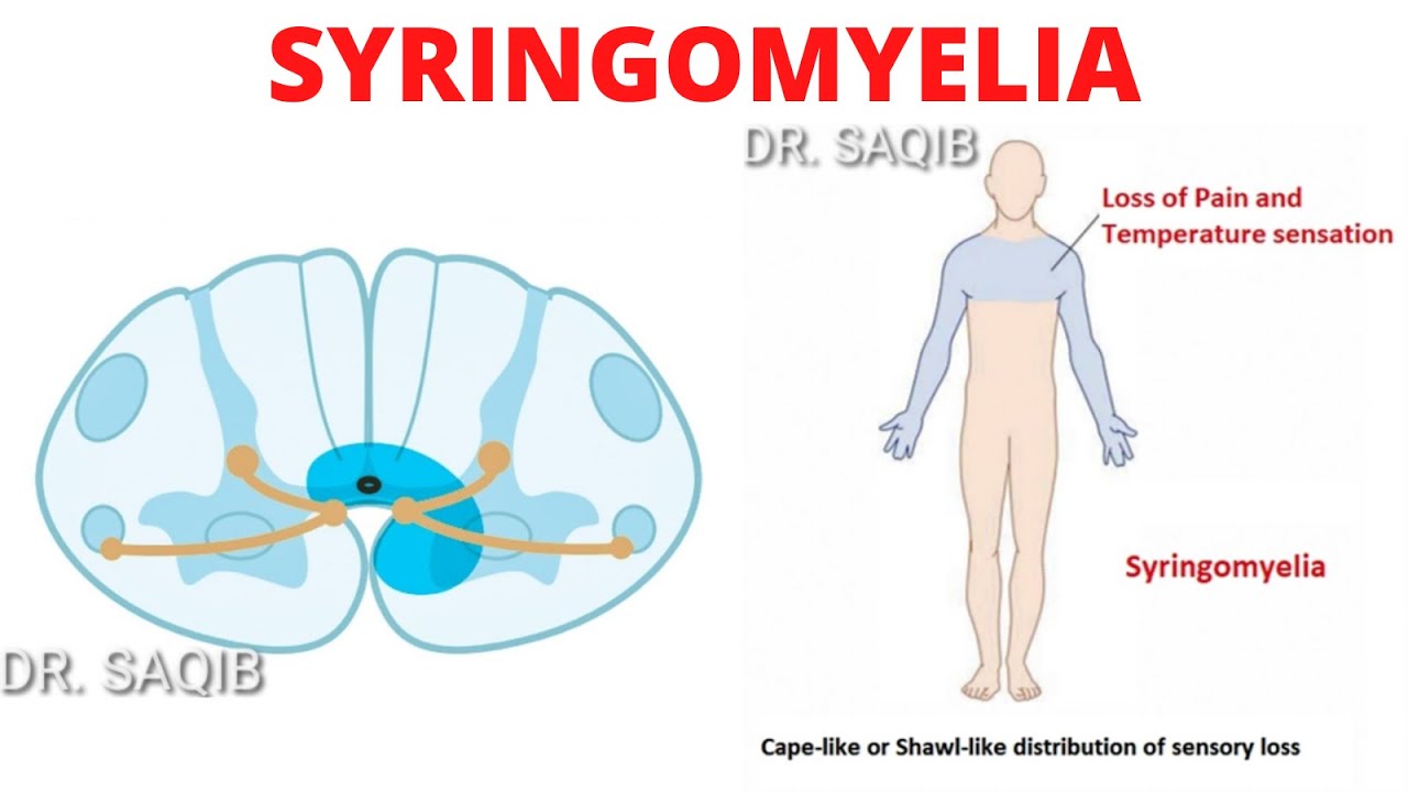 Syringomyelia Diagram