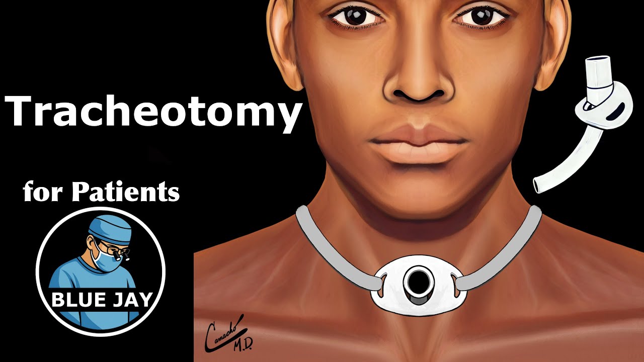 Tracheostomy: Patient Education - YouTube