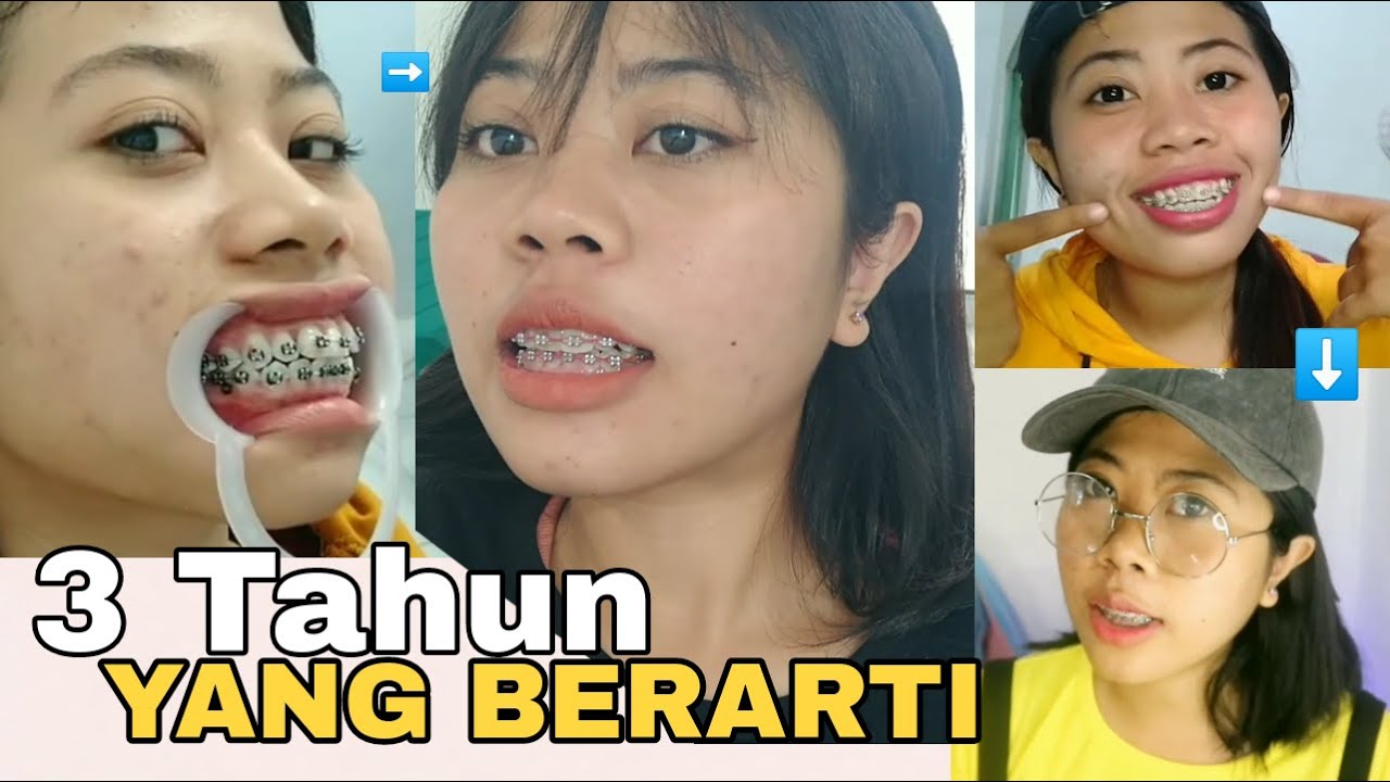 Video Perubahan wajah dan Gigi pakai behel selama 3 tahun - YouTube