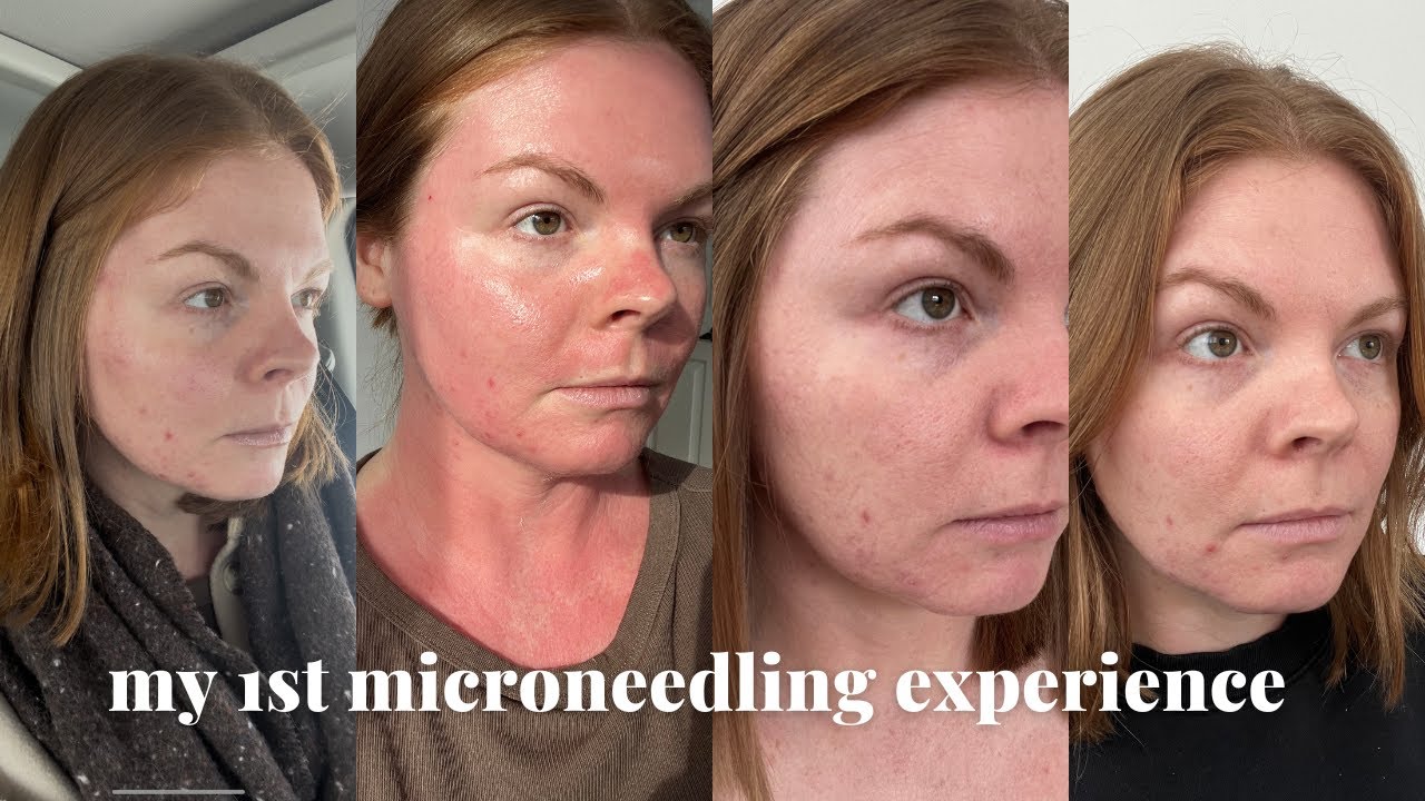 Microneedling Experience | acne scars, hyperpigmentation & building my ...