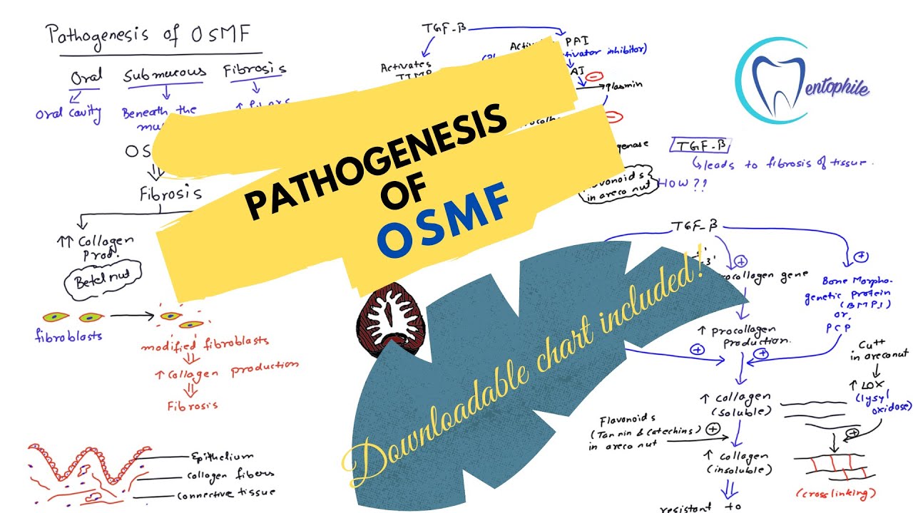 Oral Submucous Fibrosis (OSMF) | Pathogenesis (Nepali) | Oral Pathology ...