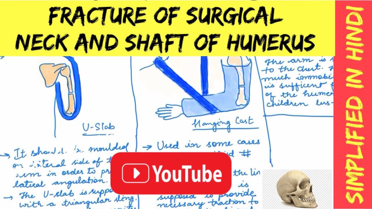 FRACTURE SURGICAL NECK OF HUMERUS, FRACTURE SHAFT OF HUMERUS ...