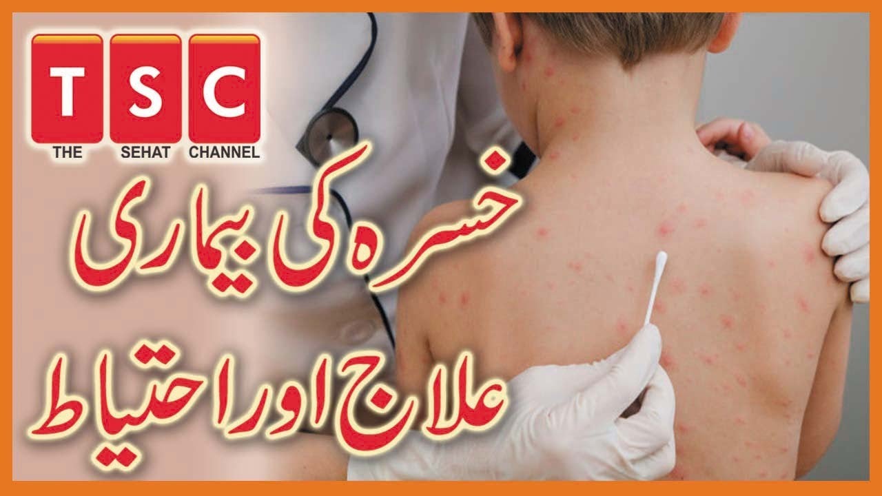 Measles Khasra Symptoms And Precautions Urdu Hindi YouTube measles-khasra-symptoms-and-precautions-urdu-hindi-youtube