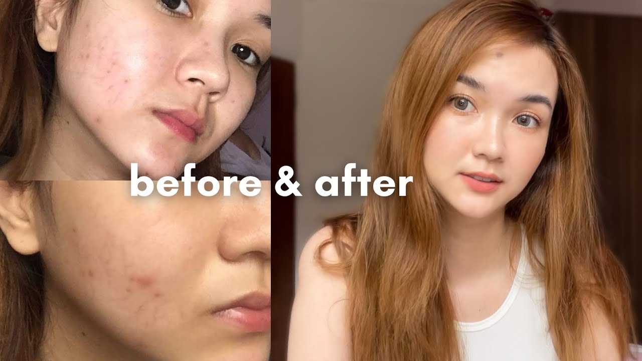 HOW I FINALLY CLEARED MY ACNE, DARK SPOTS, PIMPLE MARKS, & BLACKHEADS ...