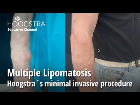 Multiple Lipomatosis- Hoogstra´s minimal invasive procedure - 23185 - YouTube