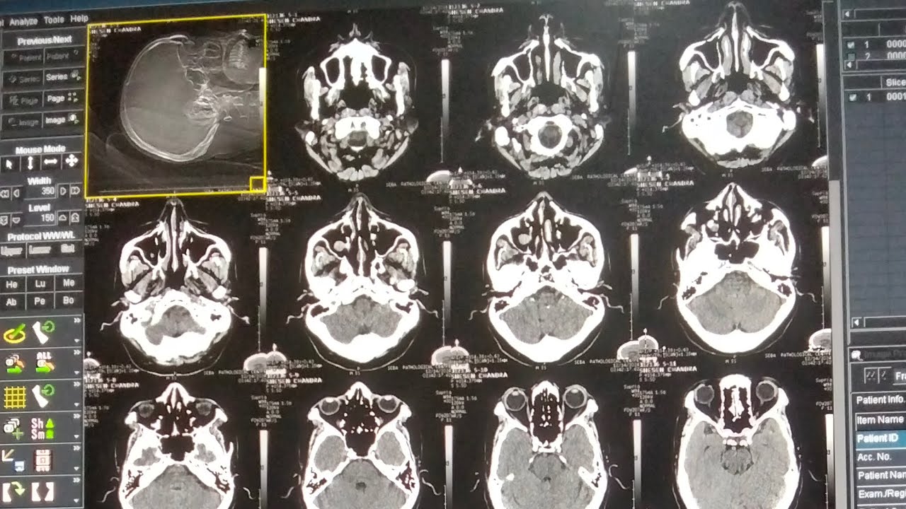 How to do Ct scan of Brain Filming series - YouTube
