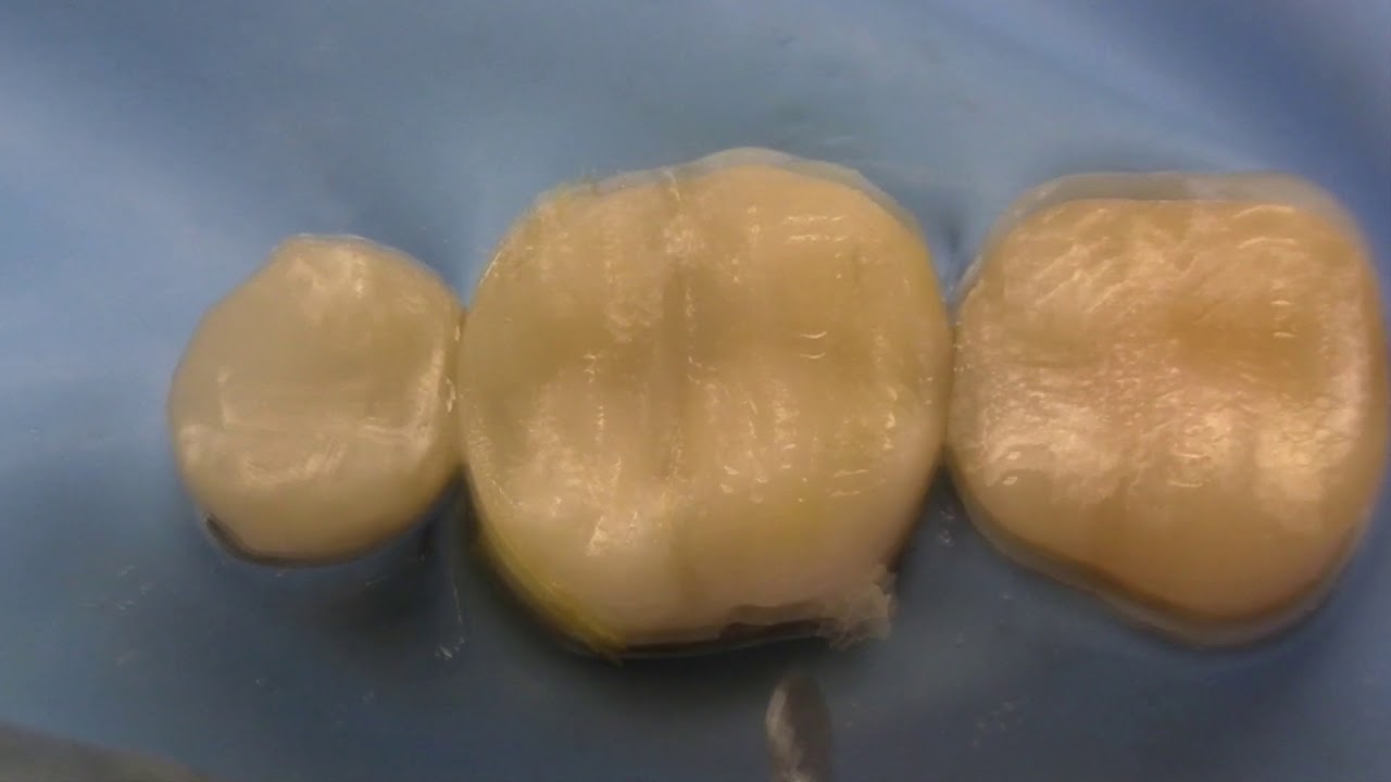 Class II - Bulk Fill - YouTube