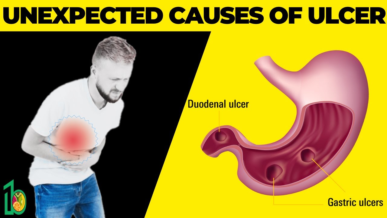 Why People Get Stomach Ulcers Breaking the Facts - YouTube