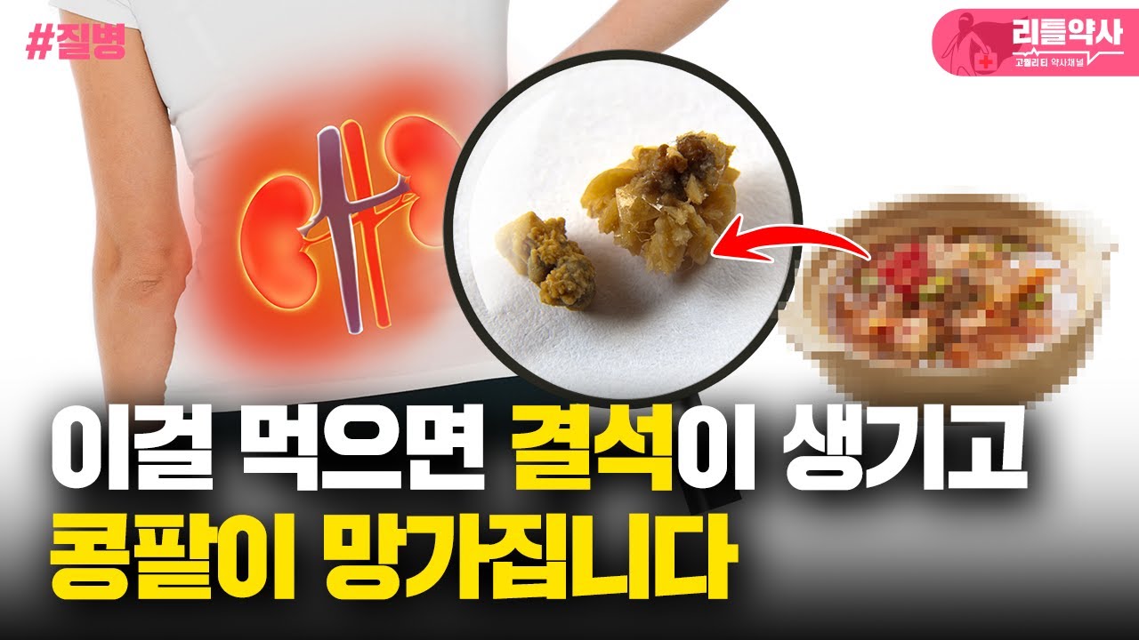 이런 음식을 드시면 신장에 돌을 만들고 콩팥이 망가집니다 신장 요로 결석에 좋은 음식과 나쁜 음식 그리고 예방하는 영양제