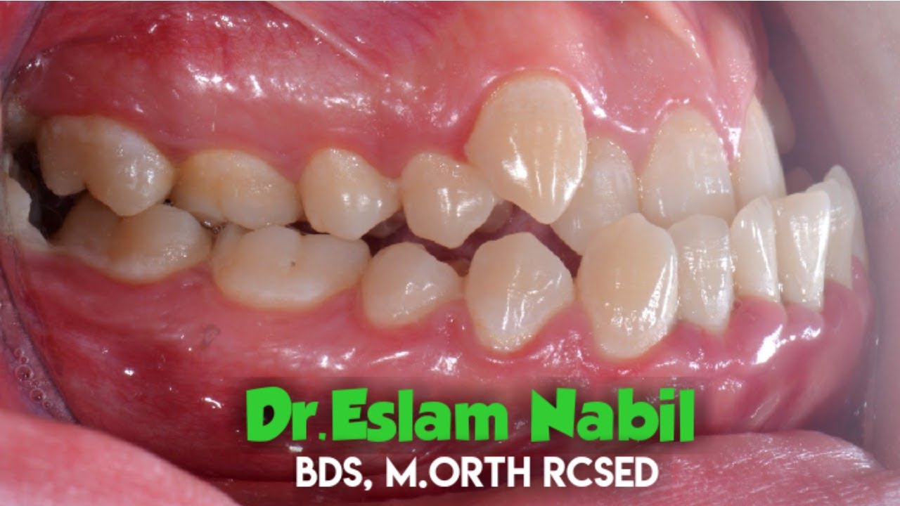 Class 3 Orthodontic Treatment - Braces - Negative Overjet تقويم العضه ...