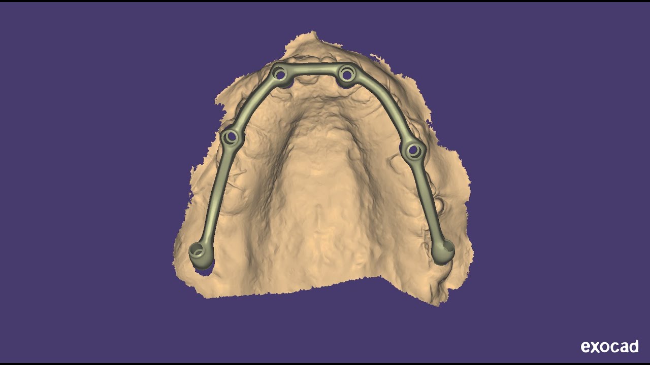 Upper all on 6 titanium bar designing for SMU implants in EXOCAD ...