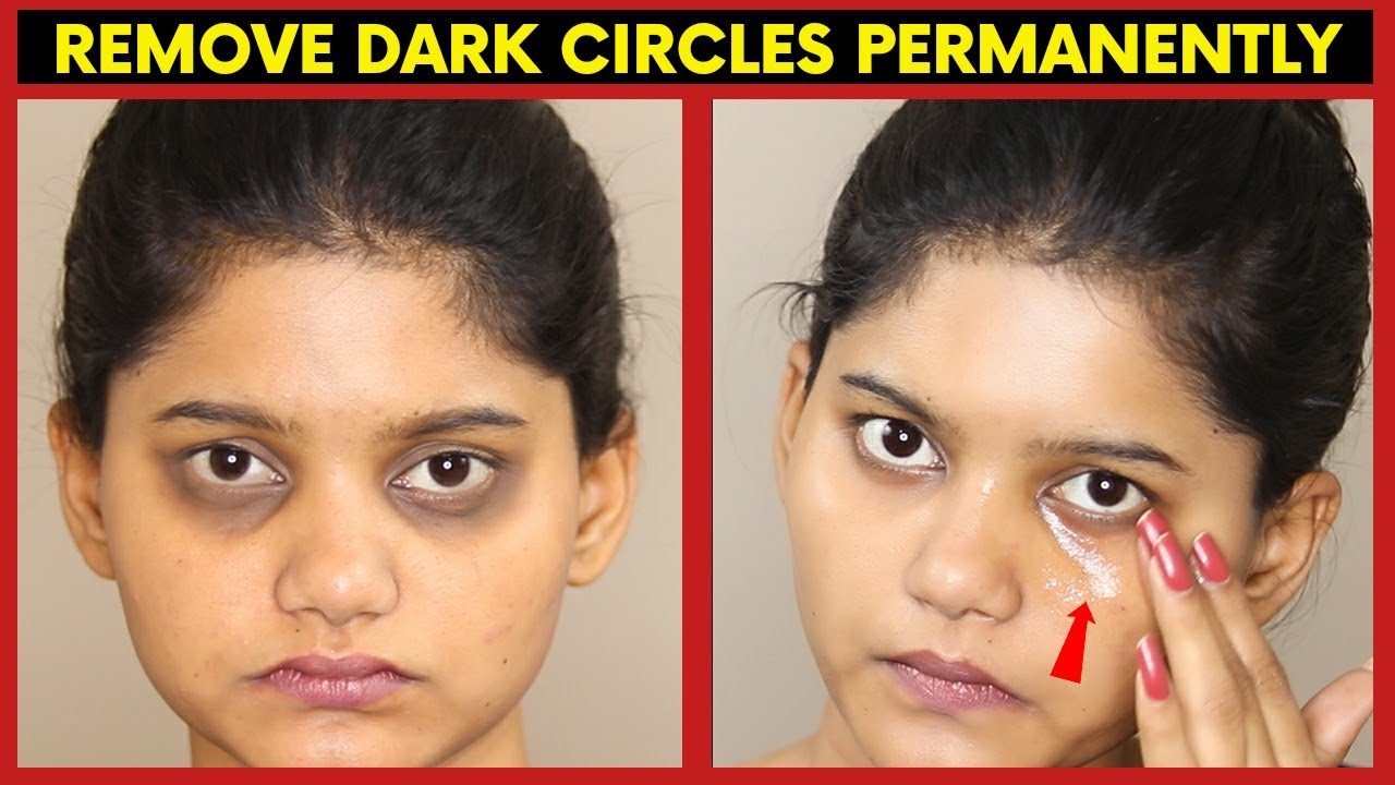Get Rid of DARK CIRCLES Naturally | Remove DARK CIRCLES Overnight ...