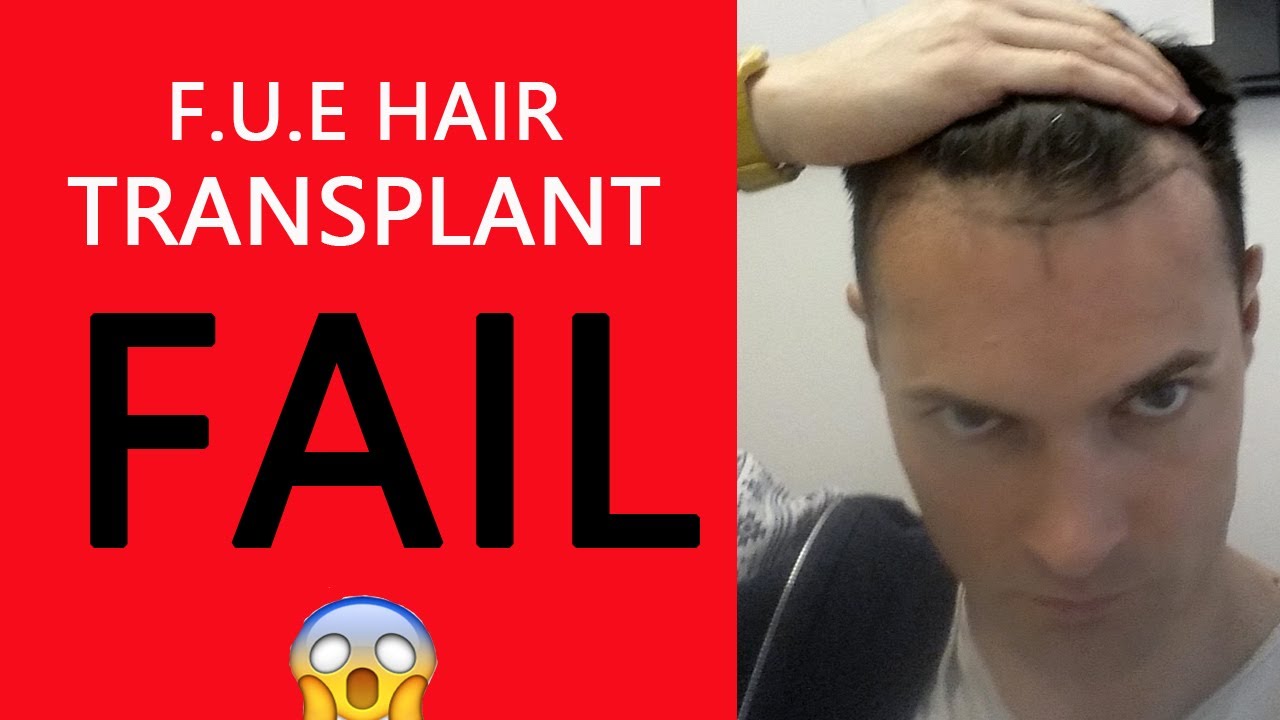 My Disaster FUE Hair Transplant Failed! FARJO HAIR INSTITUTE. - YouTube