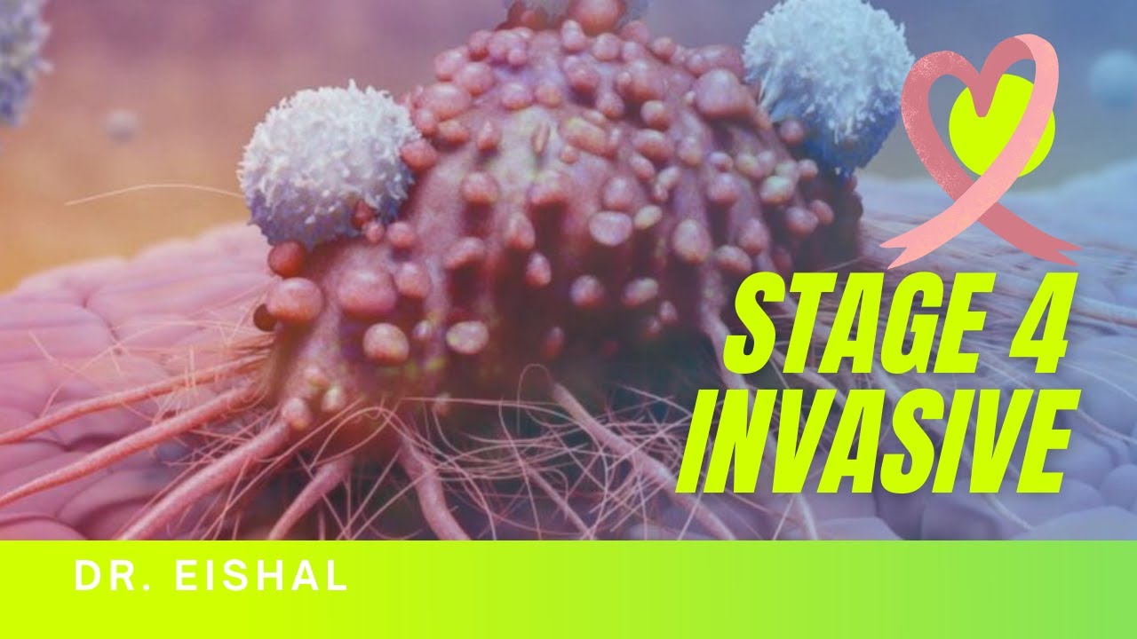 What is Stage 4 Cancer? - YouTube