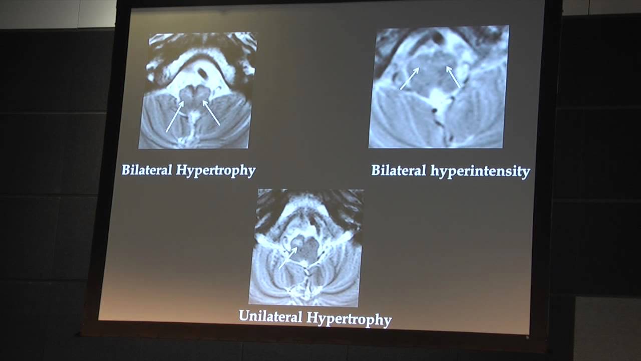 Posterior Fossa Syndrome In Children Following Brain Tumor Resection ...