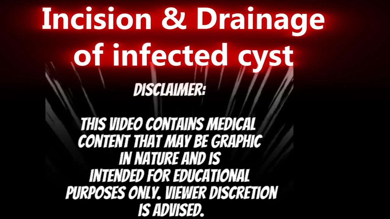 Incision and drainage of a large back abscess - YouTube