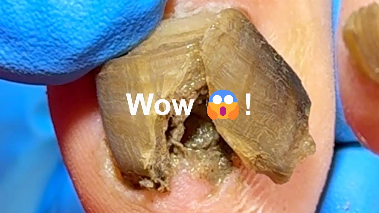 How to cut nails to remove flesh without swelling. - YouTube