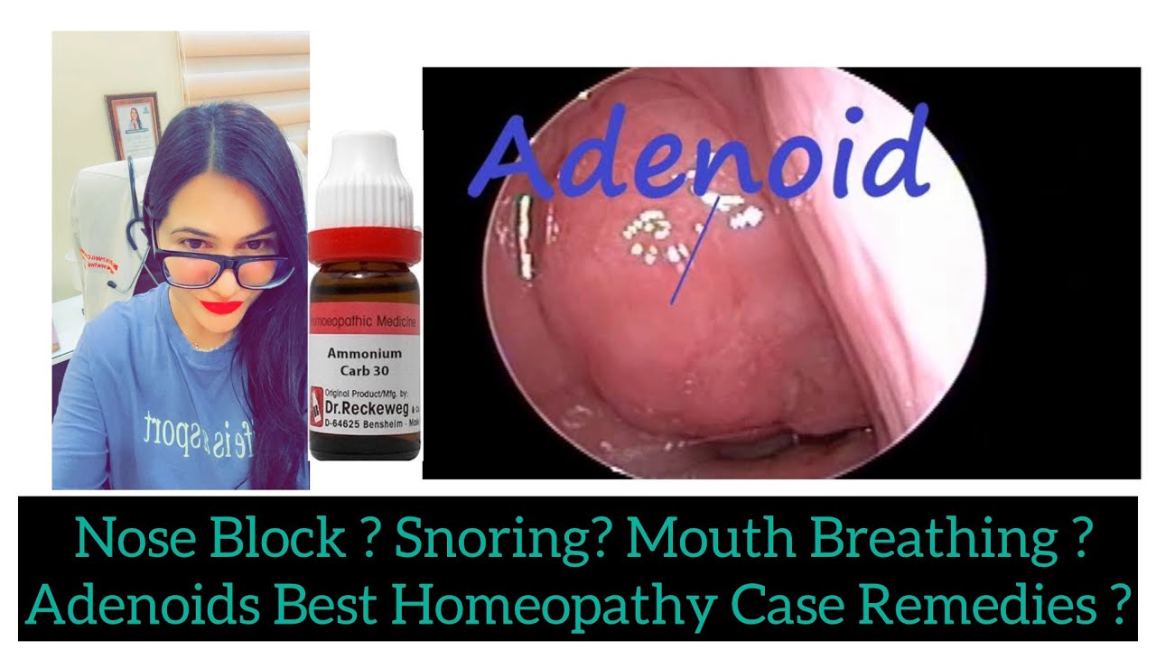 Nose Block ?Snoring Best Homeopathic Medicine? Adenoids Homeopathic ...