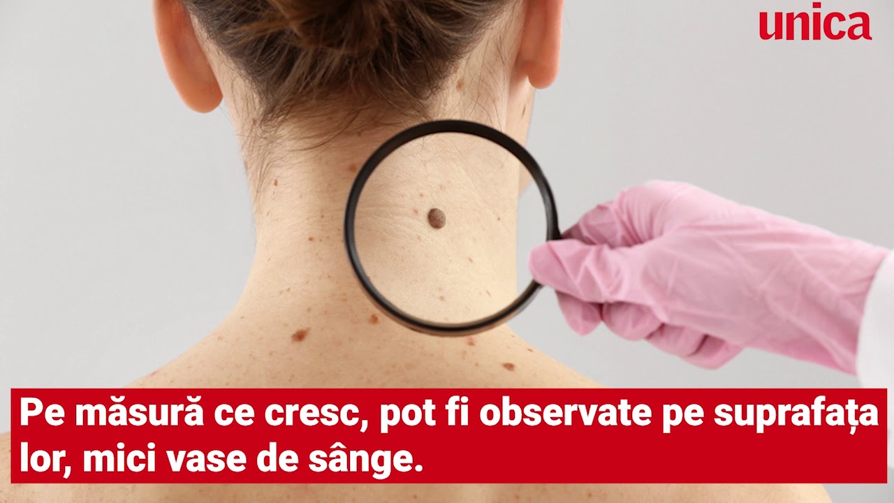 Cum recunoști cele mai comune tipuri de cancer de piele - YouTube