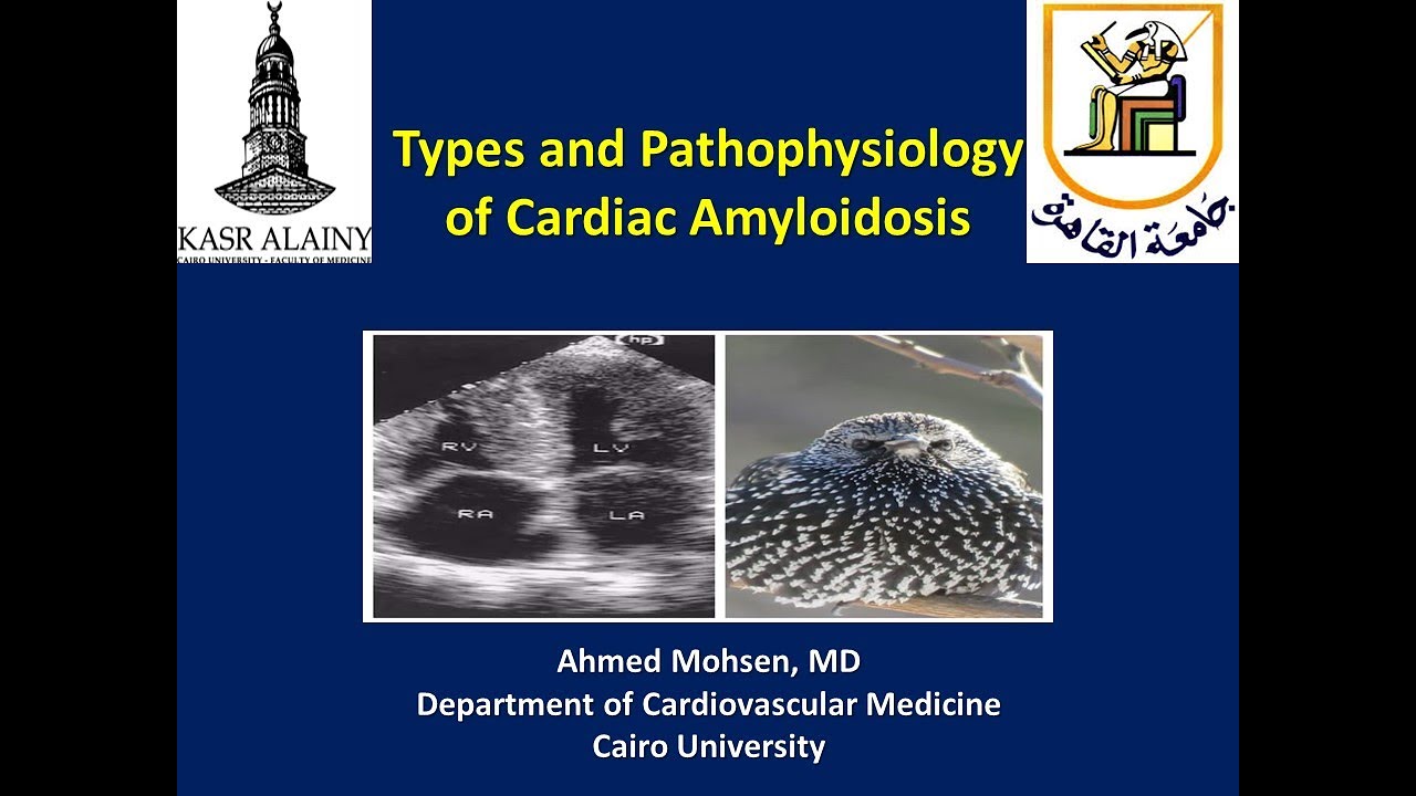 Types and Pathophysiology of Cardiac Amyloidosis - YouTube