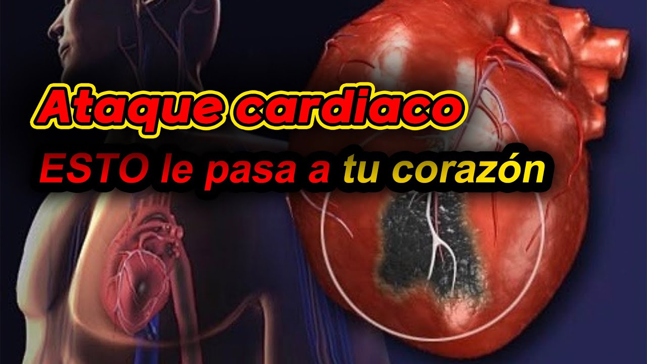 Si tienes ESTO, puede ser que "es 1 señal de Ataque cardiaco" - YouTube