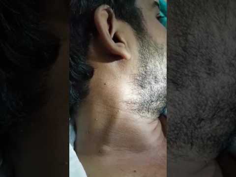 Raised jugular venous pressure - YouTube