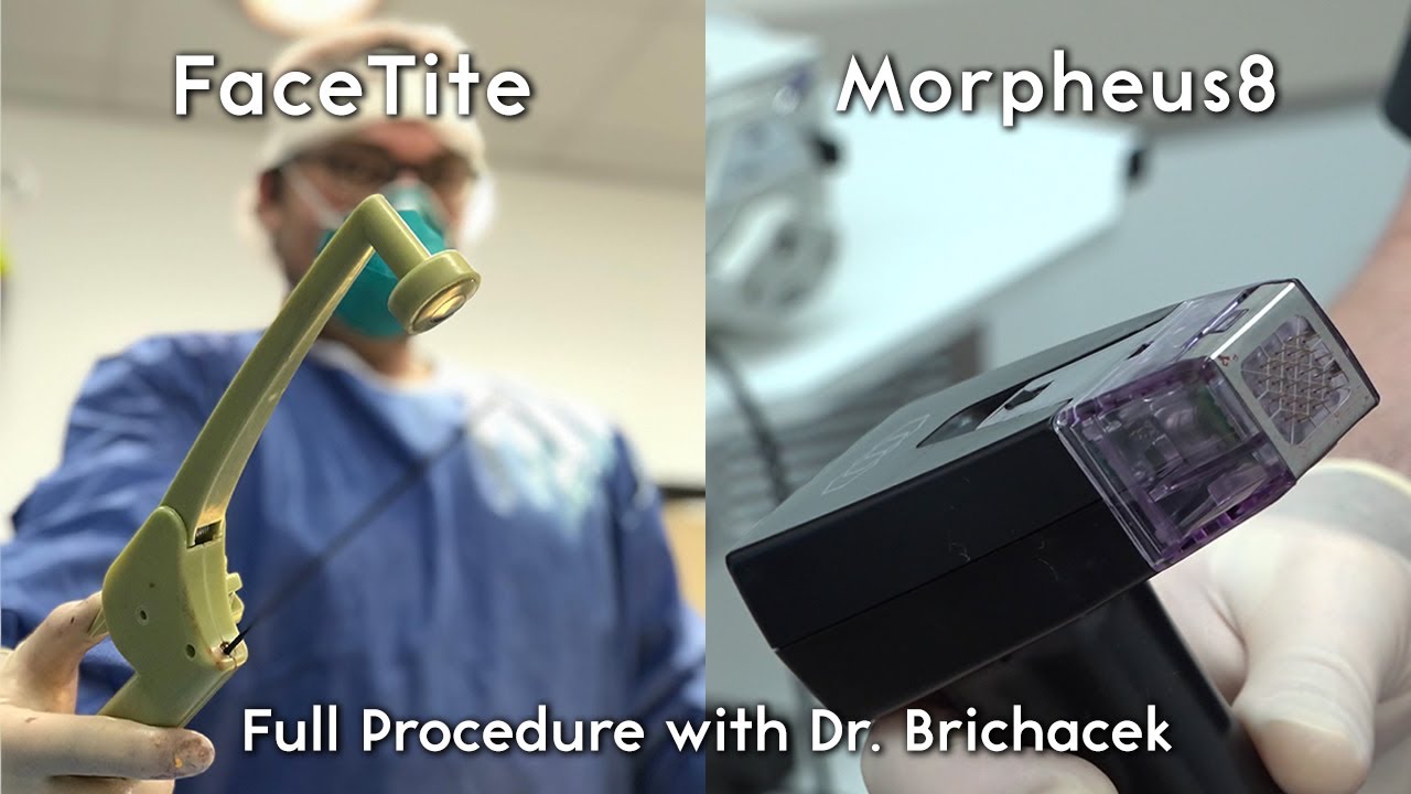 FaceTite and Morpheus8 - Full Procedure from Start to Finish - YouTube