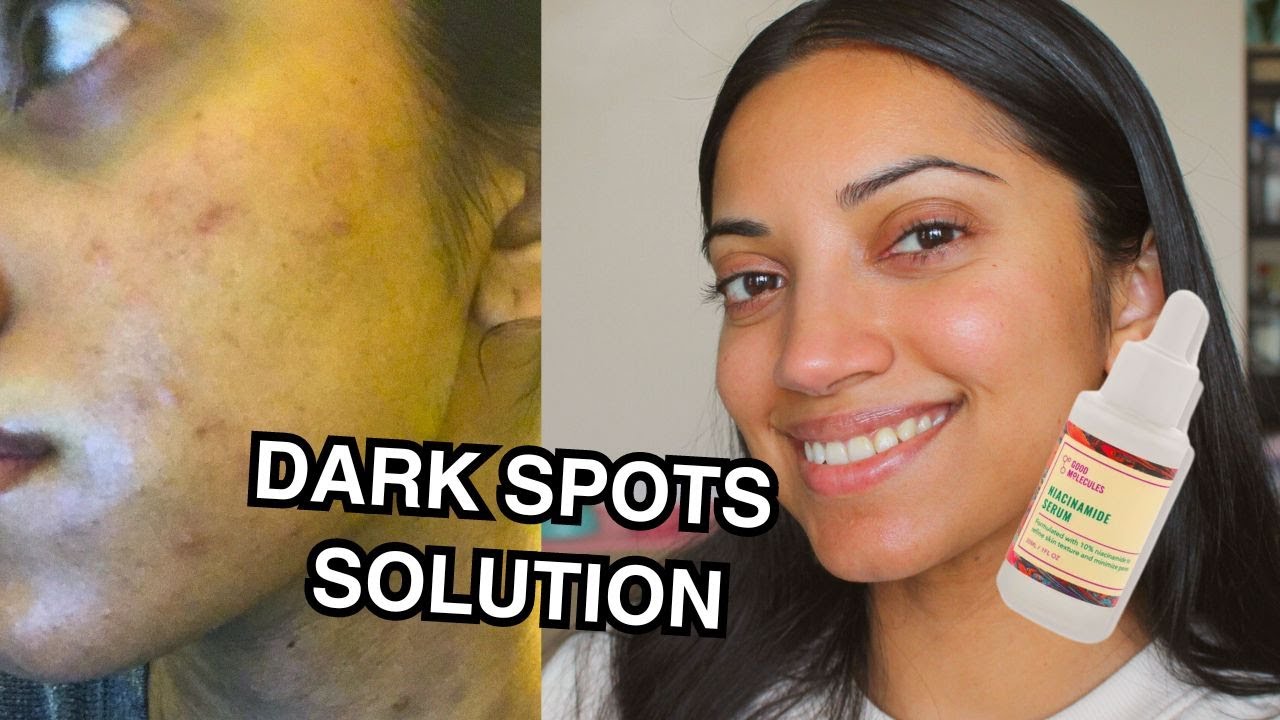 How Niacinamide Serum Faded My Hyperpigmentation/Dark Spots - YouTube
