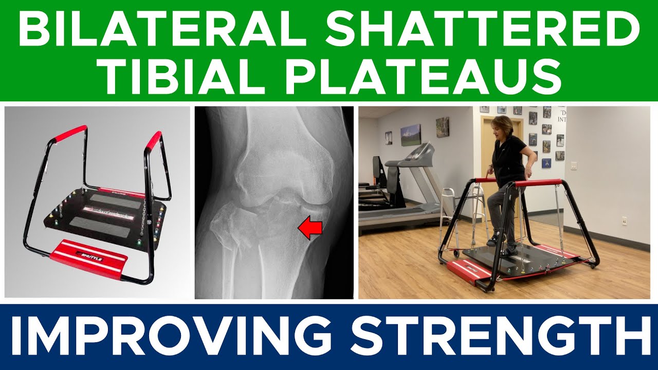 Bilateral Tibial Plateau Fractures: Improving Leg Strength | Re ...