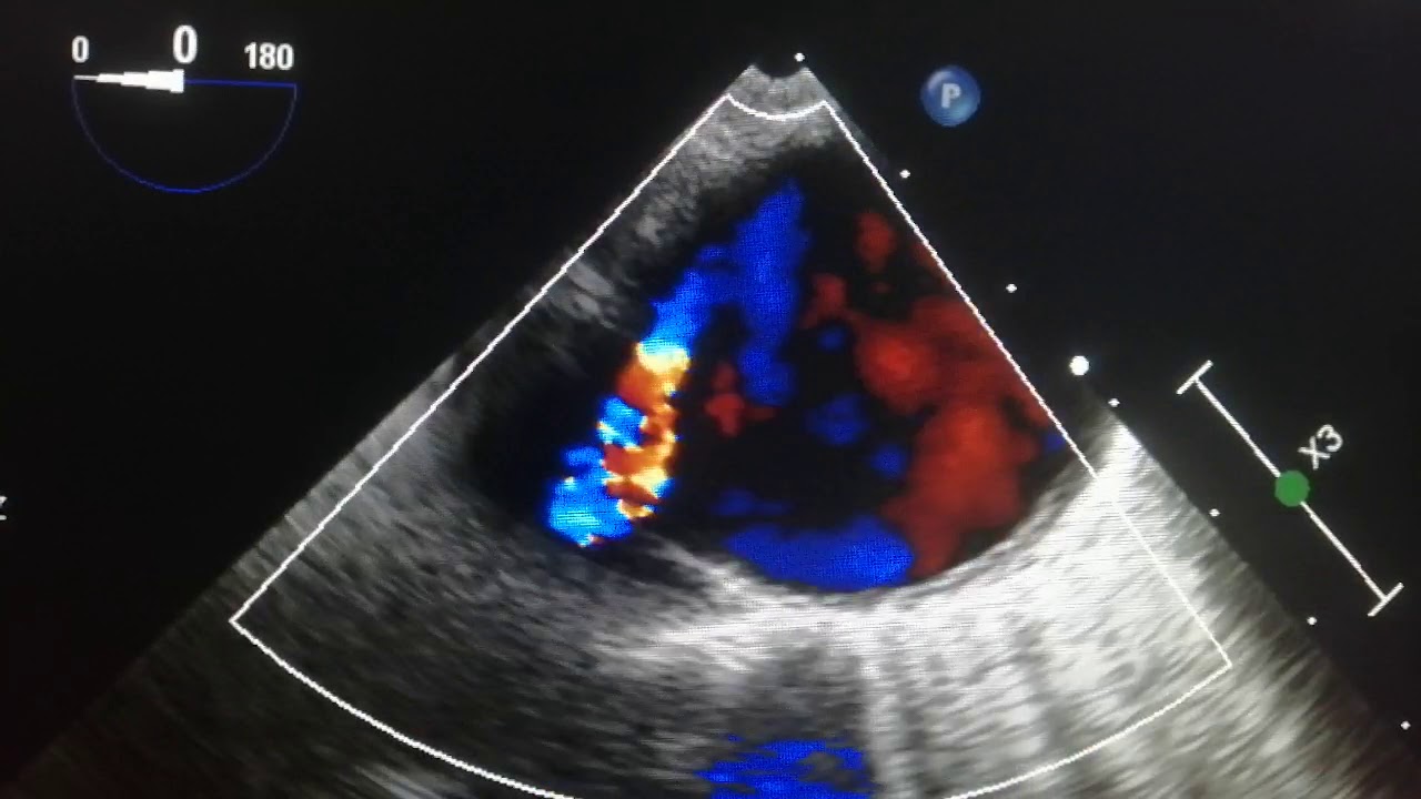 PDA, descending Aorta short axis view - YouTube