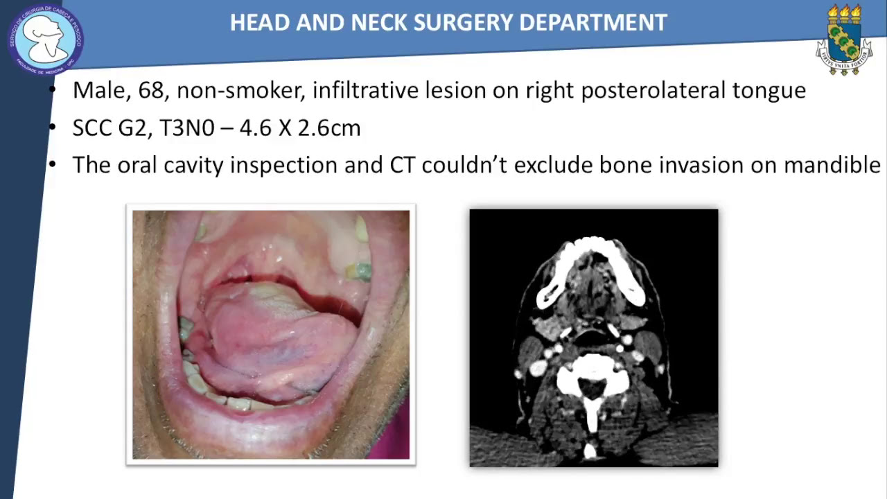 RECONSTRUCTION WITH PECTORALIS MAJOR FLAP AFTER HEMIGLOSSECTOMY - YouTube