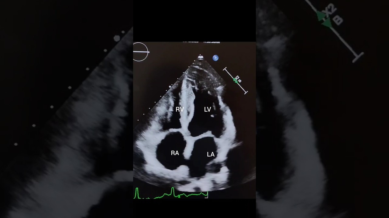 Basic Standard Echo View- Apical four chamber View (A4C). - YouTube