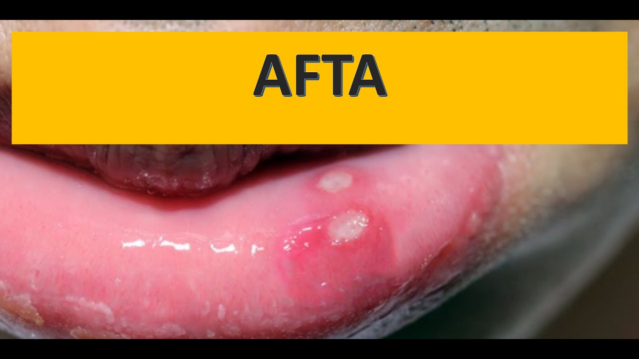 AFTAS NA BOCA E NA LÍNGUA – CAUSAS E TRATAMENTO - YouTube