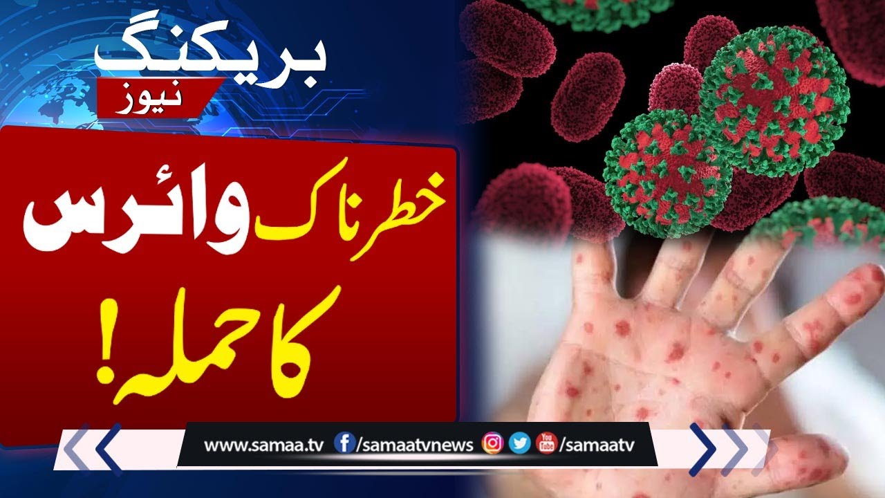 Lahore at Risk: Monkeypox Cases Rise to 21 | Symptoms & Precautions ...