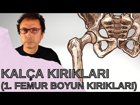 Kalça Kırıkları (1. Femur Boyun Kırıkları)