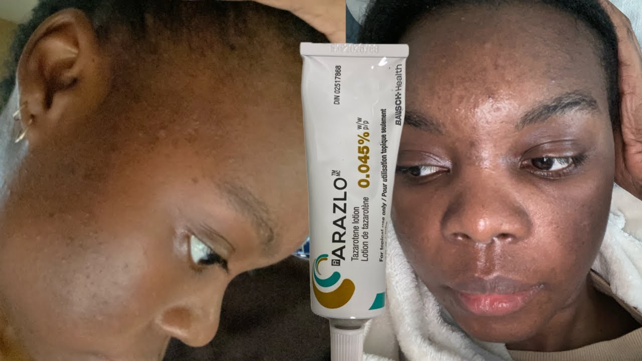 2 Months Using Arazlo - YouTube