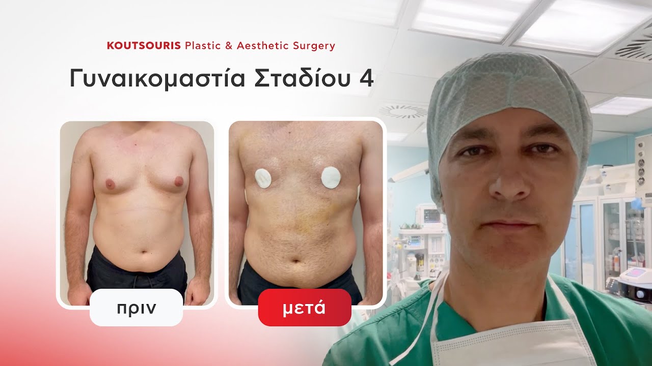 Γυναικομαστία Στάδιο 4ο - Ολόκληρο το Χειρουργείο - Μιχάλης Κουτσούρης ...
