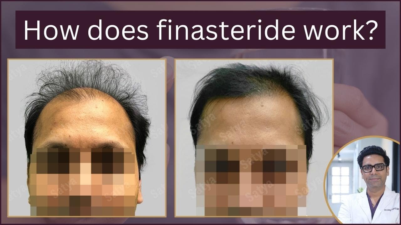 How does finasteride work | Finasteride | Finasteride before and after ...