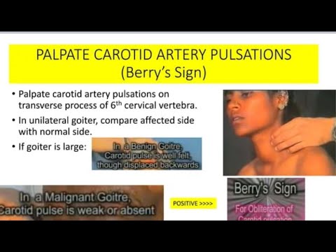 Berry's Sign| What is it, how to do and it's significance| Thyroid ...