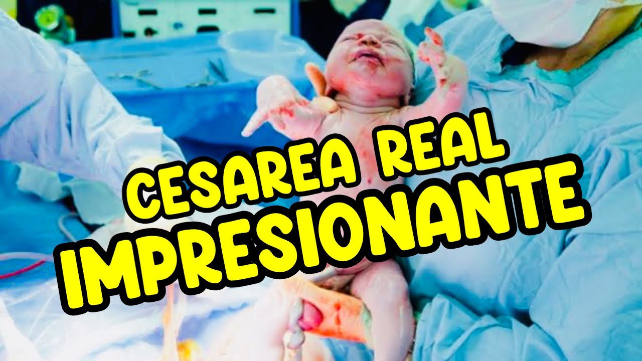 Te enseñamos el nacimiento de una bebé por cesarea. IMPRESIONANTE ...