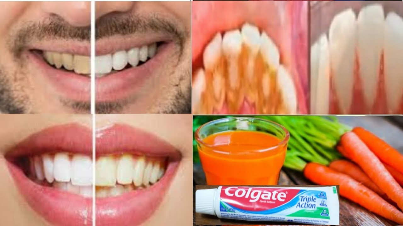 ,In 2 minutes, it will make the yellow of stained teeth white like ...