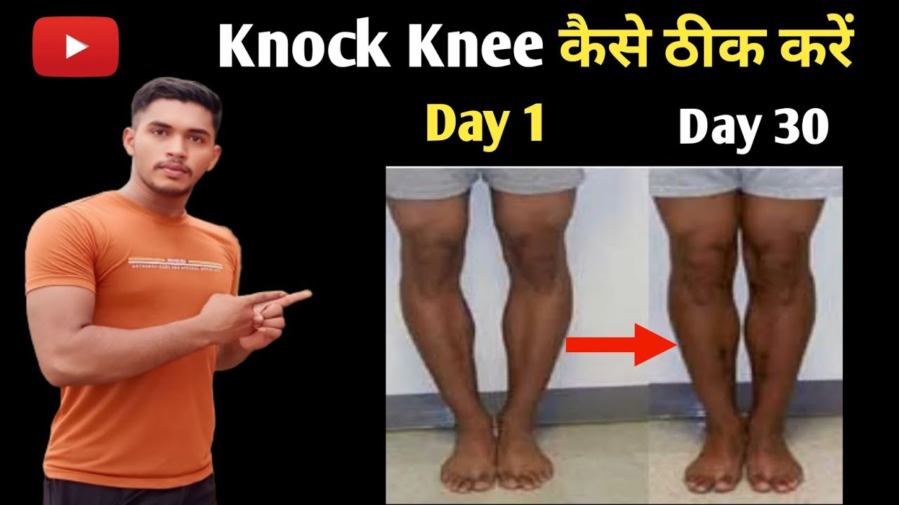 #Knock Knee Problem Solution | Knock Knee कैसे ठीक करें | Knock knees ...