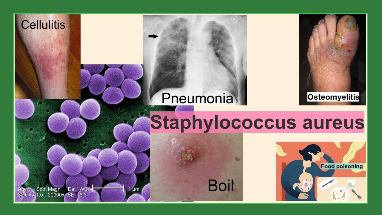 Staphylococcus aureus - YouTube