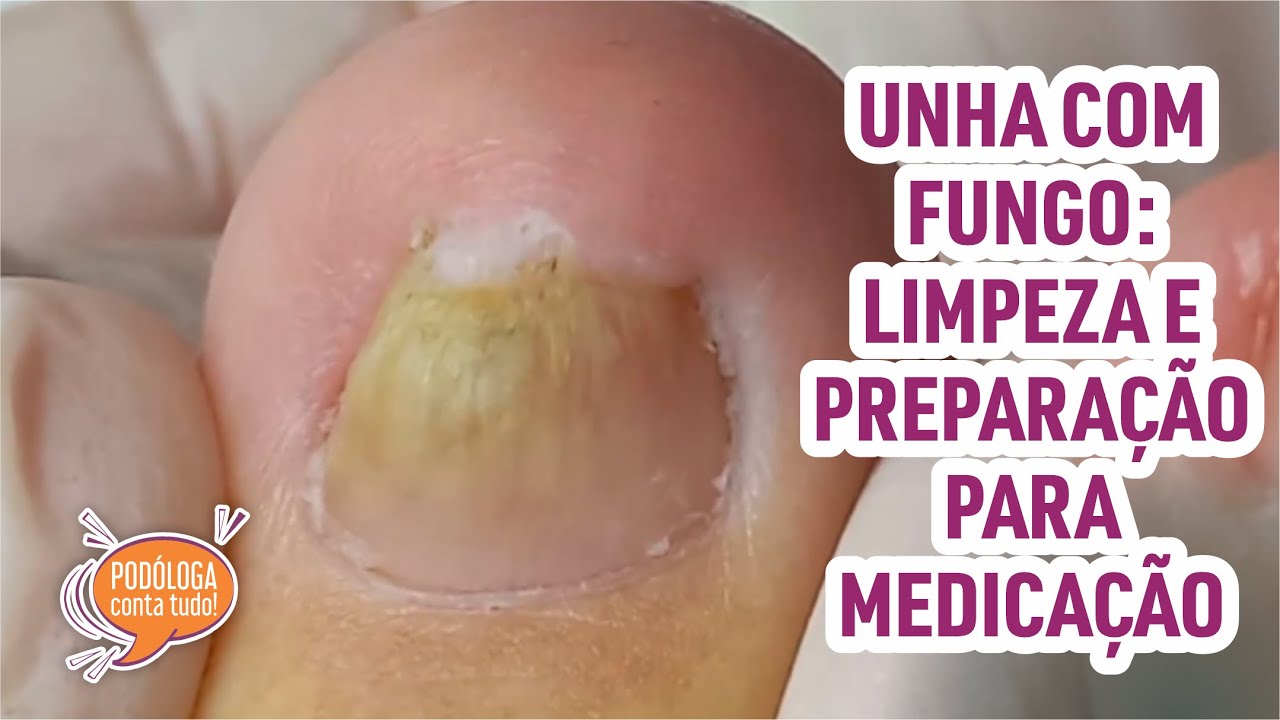 UNHA COM FUNGO: LIMPEZA E PREPARAÇÃO PARA MEDICAÇÃO - YouTube