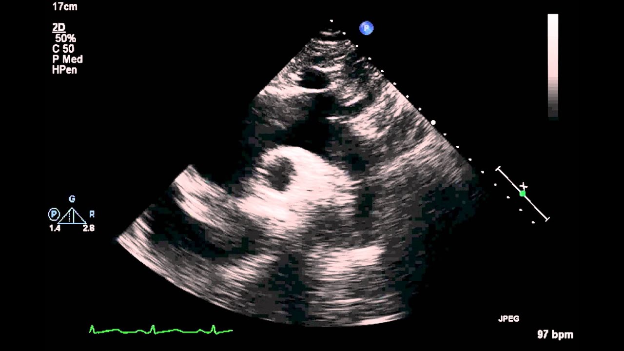 TTE Normal Suprasternal Example 2 - YouTube